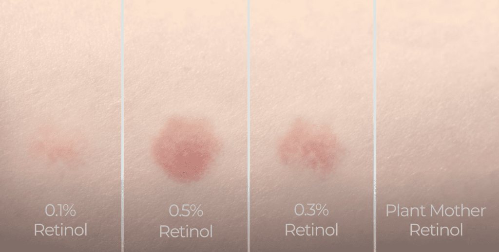 Tretinoin Purge – How To Identify and Avoid The Purge – Plant Mother
