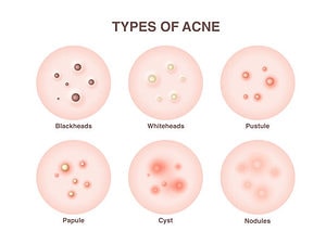 Here Are Top 10 Things You Need To Know About Hormonal Acne